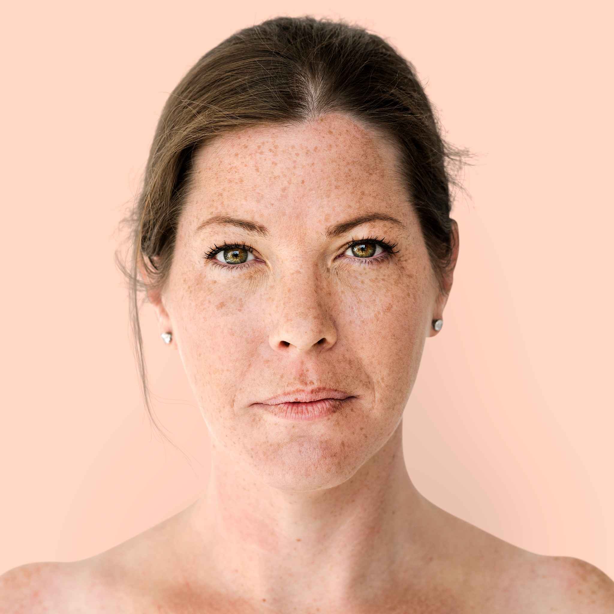 Freckle Removal Treatment | Safe & Effective Solutions