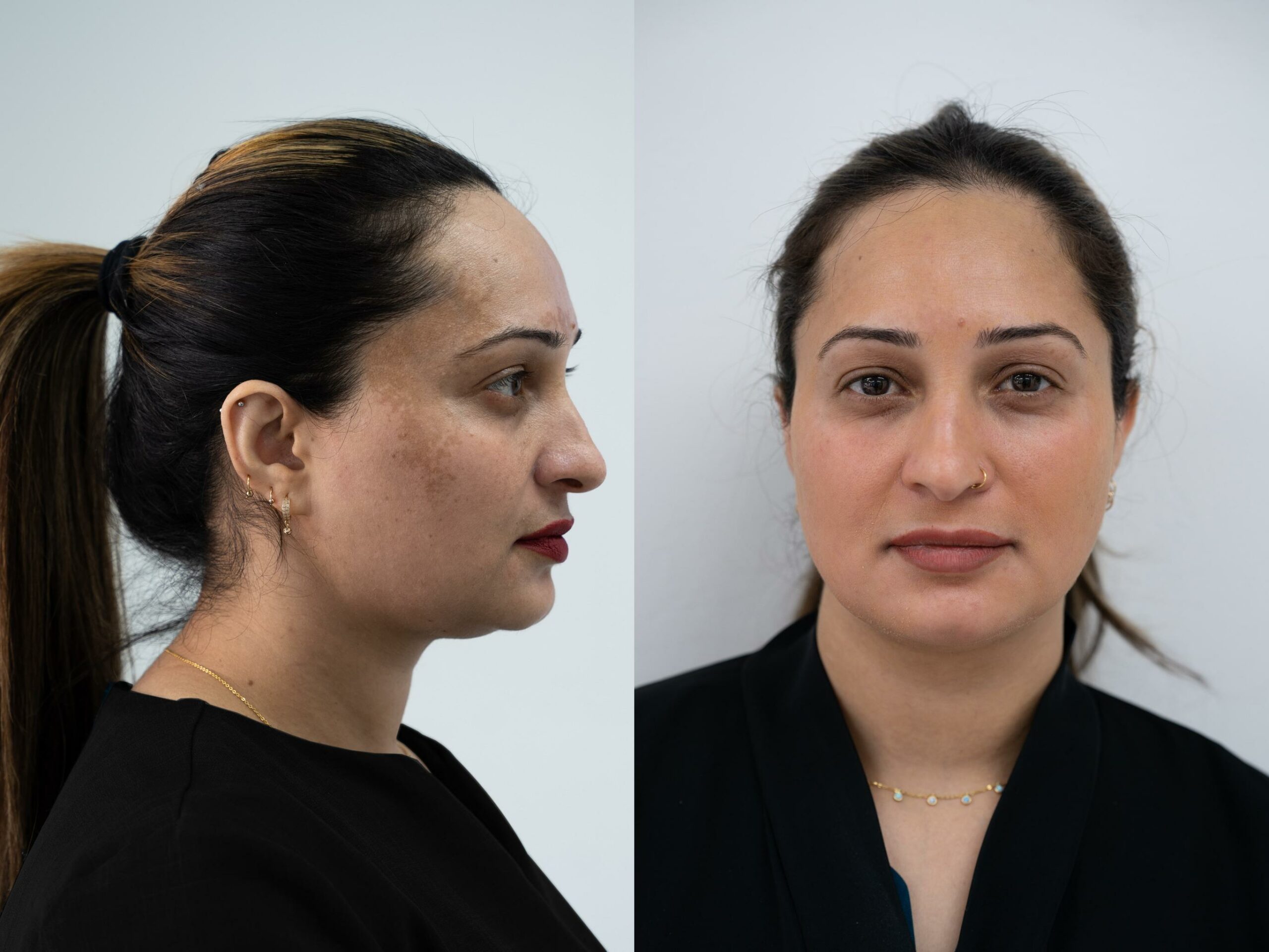Hyperpigmentation Treatment London - Shumaila's Clinic